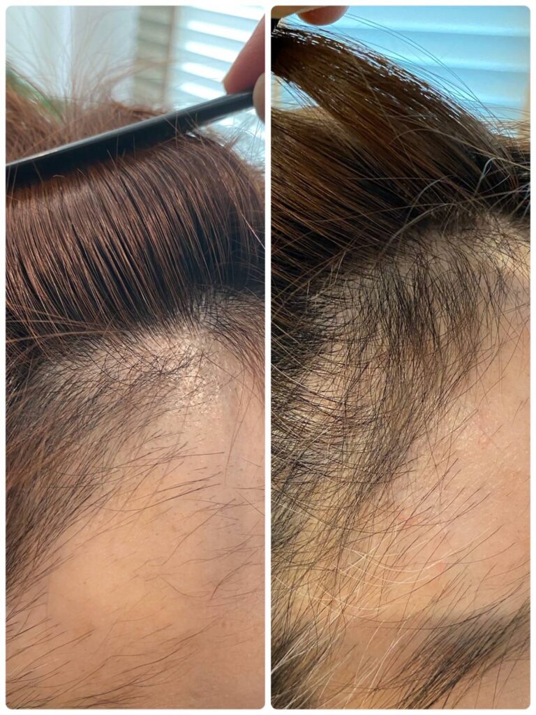 高速促進グロッティプロを使ったヘッドスパ♪ | toiro(トイロ)パーソナルヘアケア ヘッドスパ&髪質改善トリートメント専門店